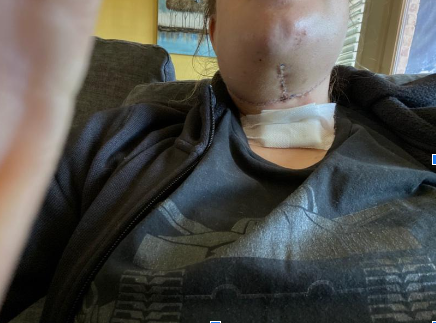 Client Study: Head/Neck Lymphedema & Radical Recovery – A Great First ...